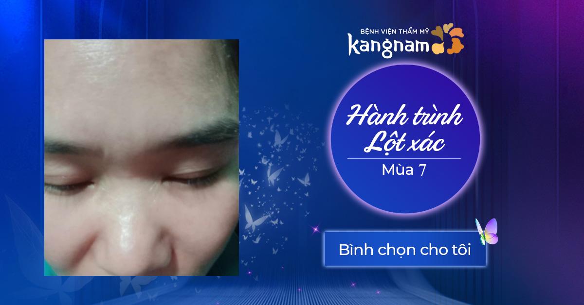 Bùi Hợm - Hành Trình Lột Xác - Bệnh Viện Thẩm Mỹ KANGNAM
